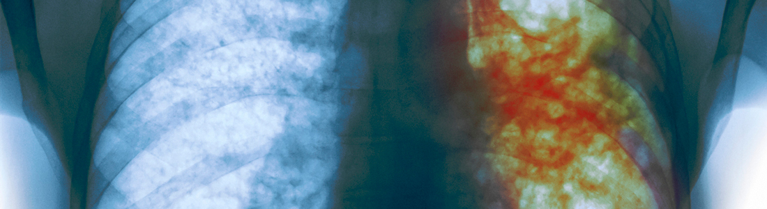 La tuberculosis resistente al tratamiento